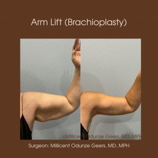 Arm Lift Before and After Photos