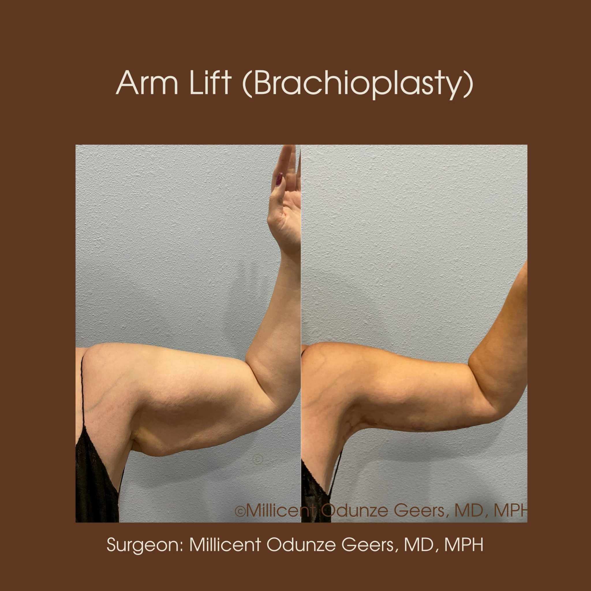 Arm Lift Before and After Photos