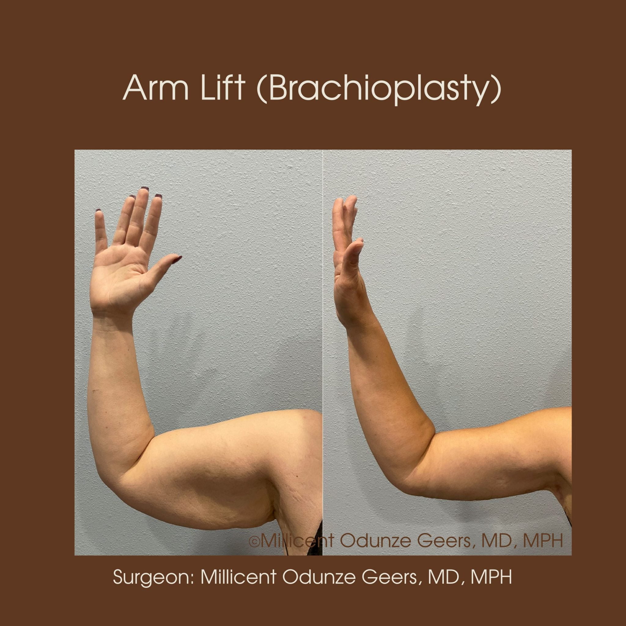 Arm Lift Before and After Photos