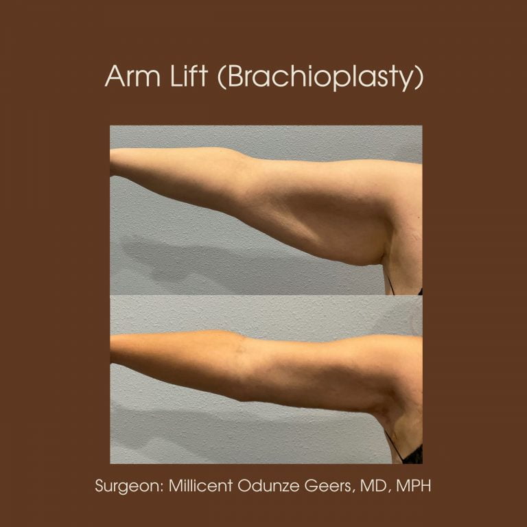 Arm Lift Before and After Photos
