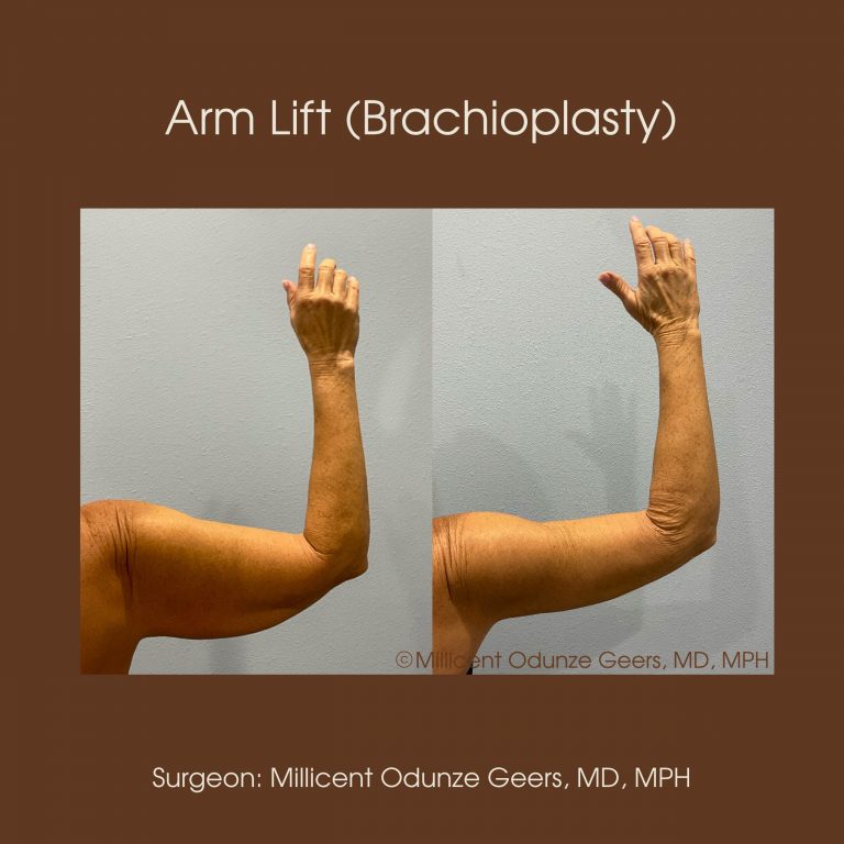 Arm Lift Before and After Photos