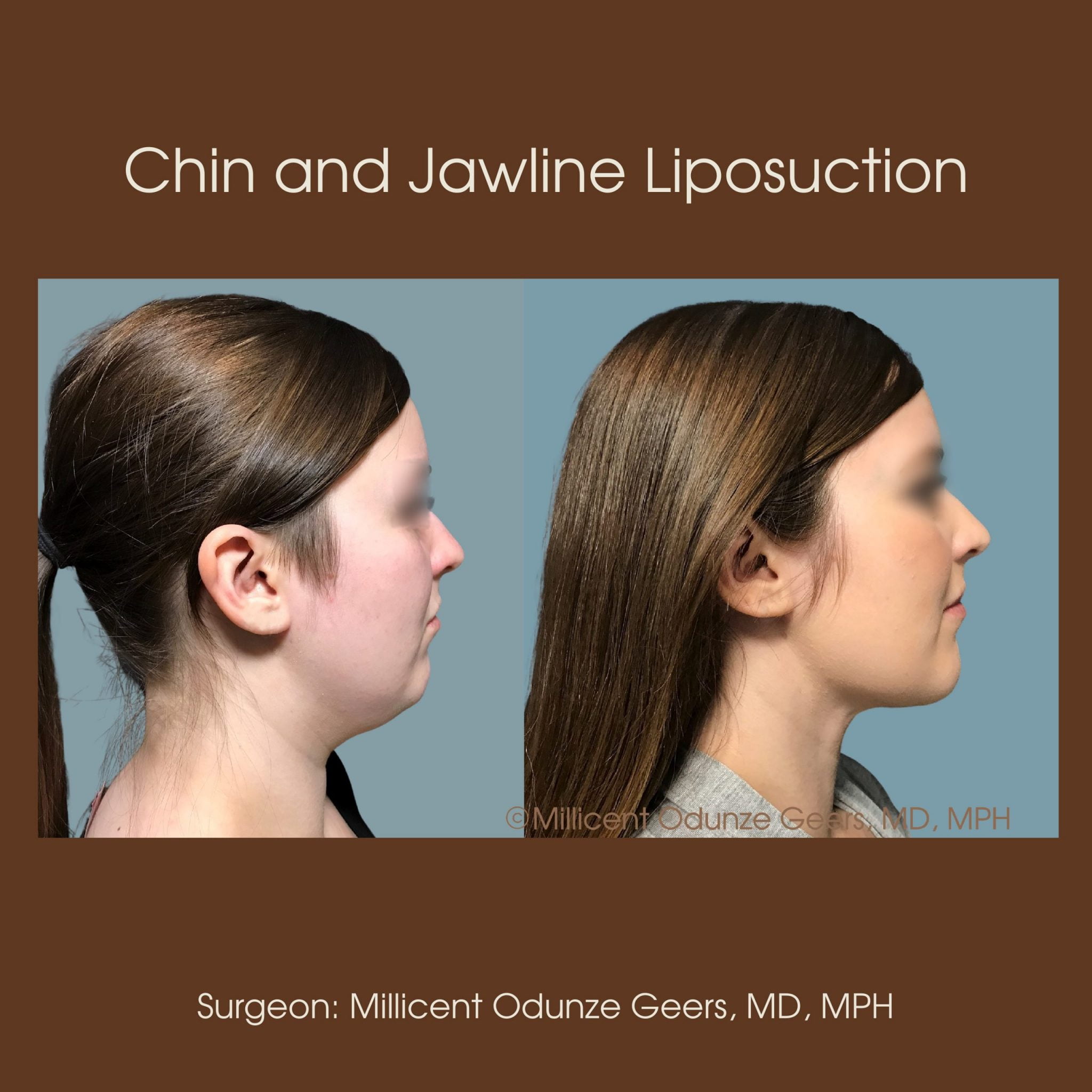 Chin Liposuction Before and After Photos