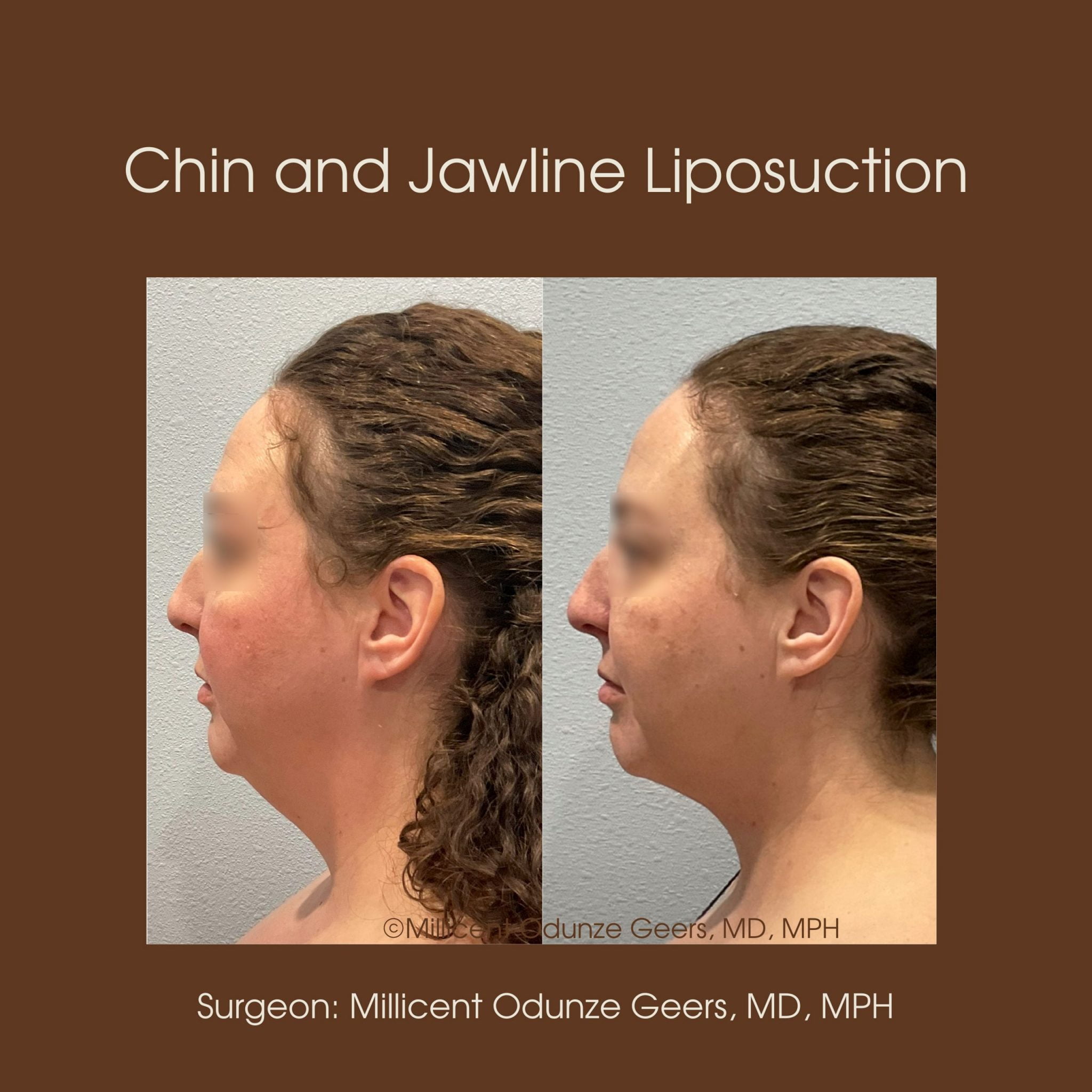 Chin Liposuction Before and After Photos