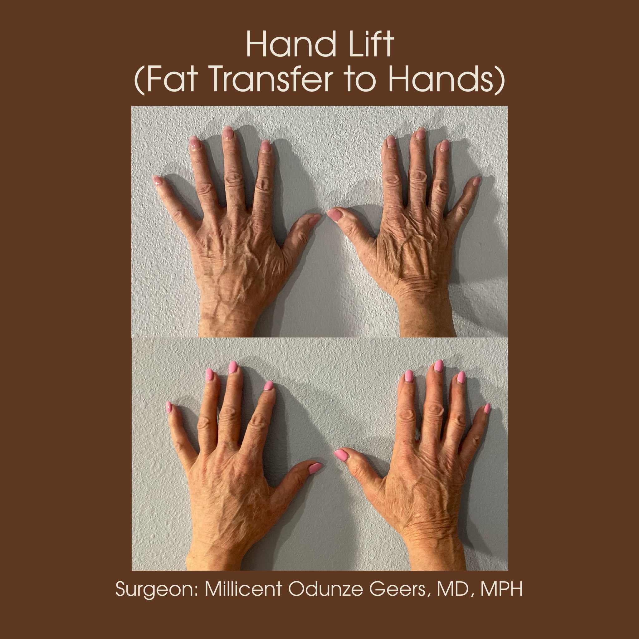 Hand Lift Before and After Photos